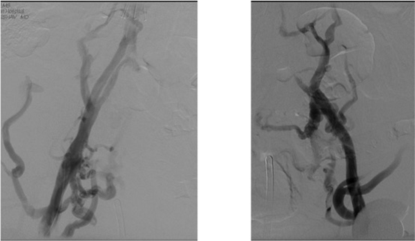 Chronic Venous Disease | Vein Treatment Center