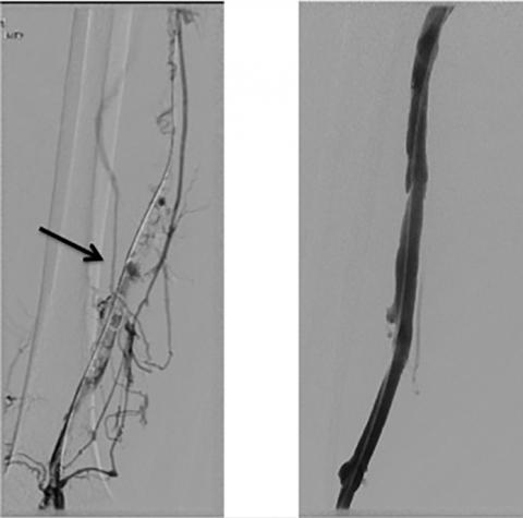 Deep Vein Thrombosis (DVT) | Vein Treatment Center