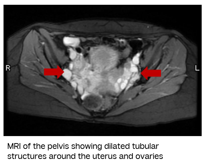 Pelvic Congestion Syndrome Vein Treatment Center